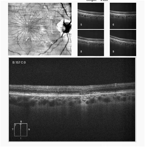 Midd Maternally Inherited Diabetes And Deafness Oct Od Retina Image Bank