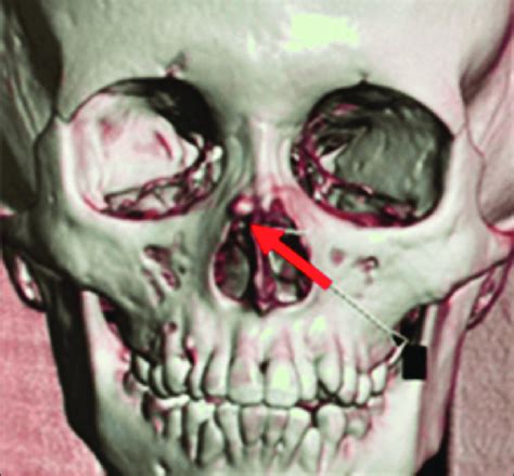 Ct Scan Of Paranasal Sinuses And Ct Scan 3d Download Scientific Diagram
