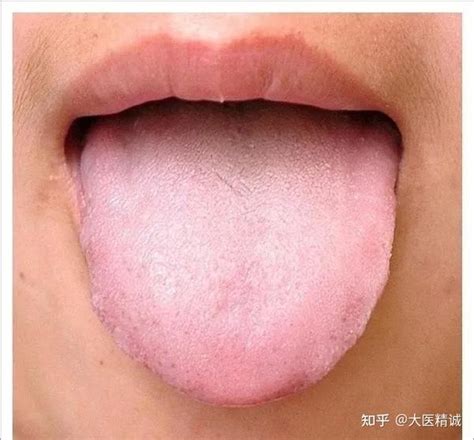 中医舌诊25张临床高清舌诊图附带解析史上最全 知乎