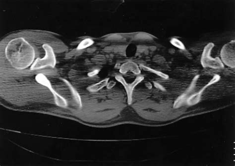 Osteoid Osteoma Of The Scapula Two Cases Studied With Ct And Mr