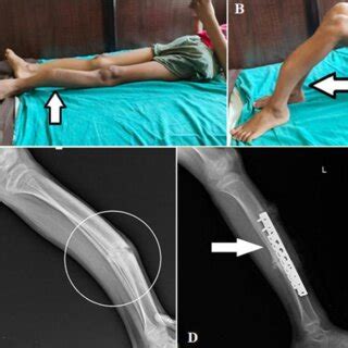 A Angular Curvature Of The Tibia And Fibula Left Side B Left Lower Download Scientific