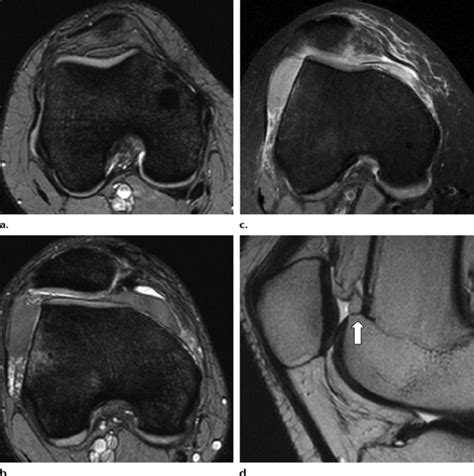 Four Types Of Trochlear Dysplasia According To The Classification Of Download Scientific