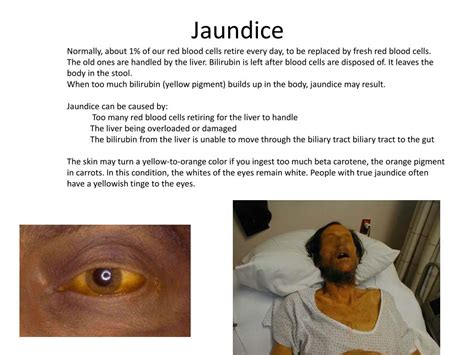 PPT A Ppendicitis Inflammation Of The Appendix PowerPoint Presentation ID