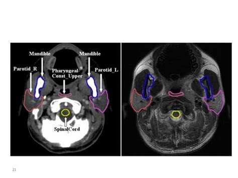 Atlas Of Organs At Risk Delineation Head And Neck Region
