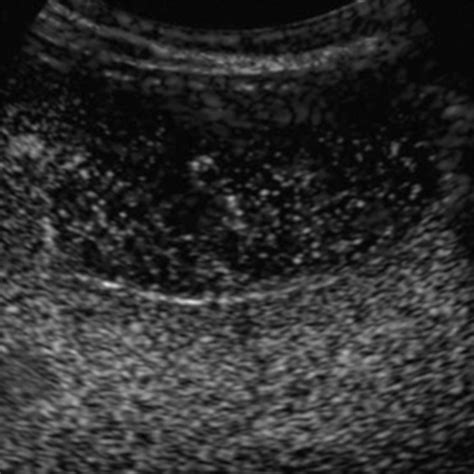 Focal Nodular Hyperplasia And Hepatic Adenoma Differentiation With Low