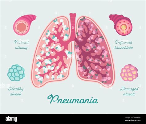 Pneumonia Mucus In Lungs