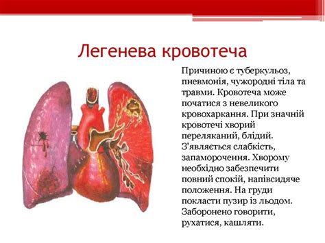 Перша допомога при кровотечах презентация онлайн