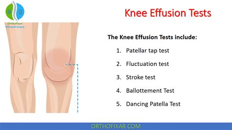 What To Do With Joint Effusion At Dorothy Bufkin Blog