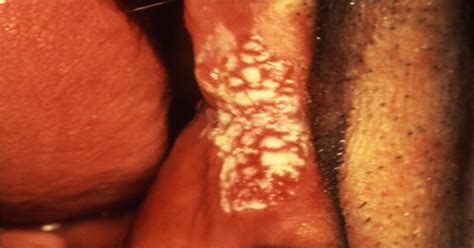 O Que É Eritroleucoplasia E Como Tratar Essa Doença