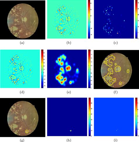Figure 8 From Automated Lesion Detectors In Retinal Fundus Images Semantic Scholar