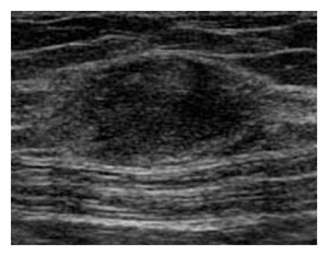 A Usg In The Transverse Plane Showing Echogenic Subcutaneous Mass Download Scientific