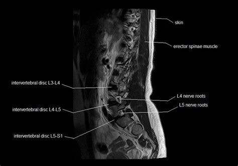 Mri Spine Anatomy Free Mri Lumbar Spine Sagittal Cross Sectional Anatomy