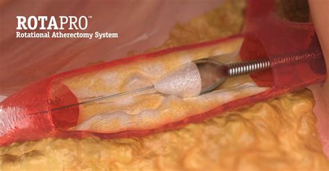 Boston Scientific Cardiology On Linkedin Atherectomy