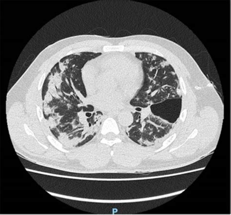 Tension Pneumothorax In A Patient With Covid 19 Bmj Case Reports