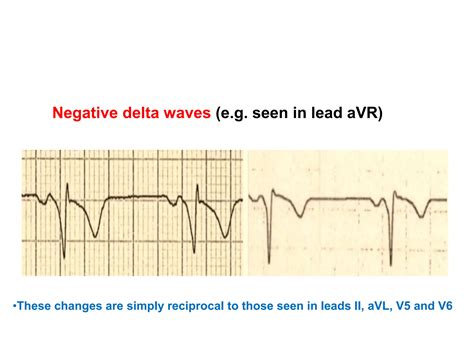 Ddelta Wave In Ecg And Its Interpretation In Ecg Pptx