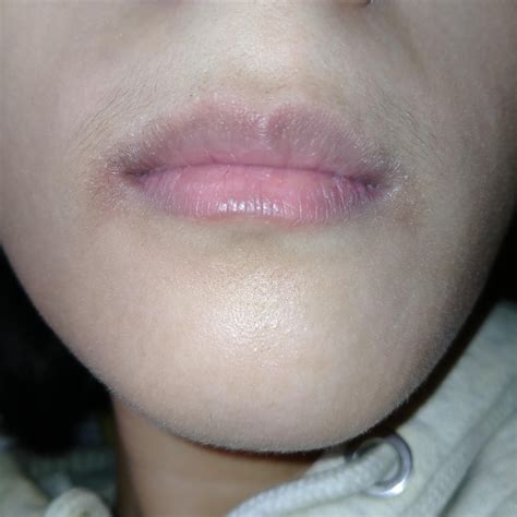I Have Angular Cheilitis And Idk If Its Caused By Saliva Or My