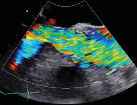 Obstruction Of The Left Ventricular Outflow Tract In Color