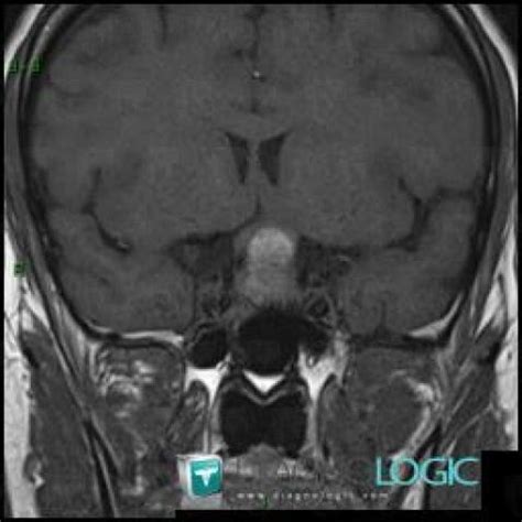 Cas radiologie Macroadénome hypophysaire IRM Diagnologic