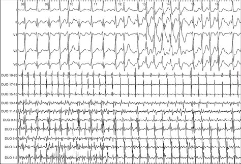 Flutter Auricular 11 Tras La Administración De Vernakalant Para