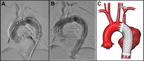 Endovascular Repair Of Descending Thoracic Aortic Aneurysms Advances