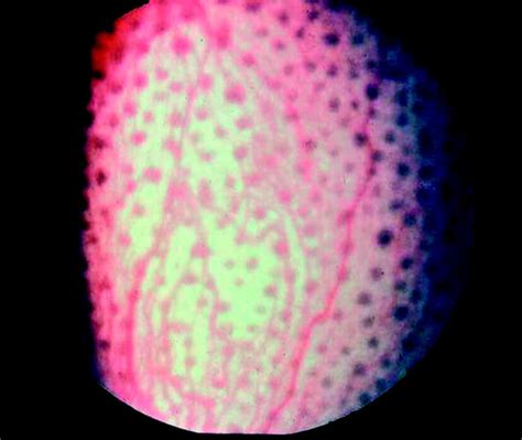 Leopard Spot Retinal Pigmentation In Infancy Indicating A Peroxisomal