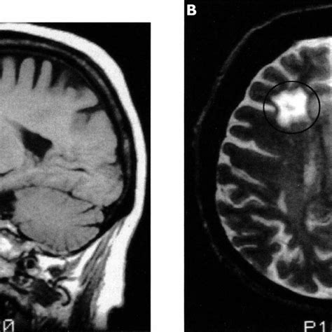 Pdf Smooth Pursuit Eye Movement Performance In A Prefrontal Leukotomy