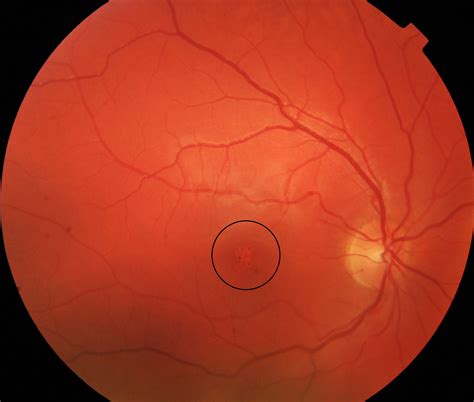 Laser Eye Damage Chart At Dale Duffin Blog
