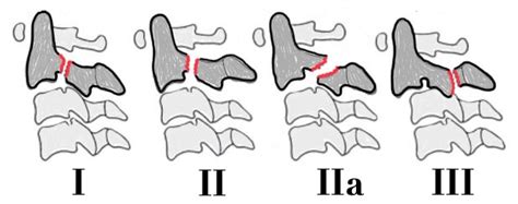 Hangmans Fracture Of C2