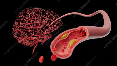 Atherosclerosis And Vascular Dementia Connection Conceptual