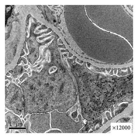 Electron Microscopy Irregular Thickening Of The Gbm And The Fusion Of Download Scientific