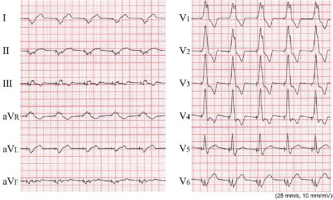 Figure2the Post Implantation Electrocardiography At Rest Under Pacing Download Scientific