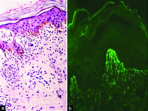 Immunofluorescence In Dermatology A Brief Review Journal Of Skin And Sexually Transmitted