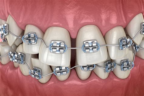 비정상적인 치아 위치 및 금속 중괄호 Tretament 의학적으로 정확한 치과 3d 일러스트레이션 금속에 대한 스톡 사진 및 기타 이미지 Istock