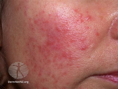 Lupus Rash Vs Rosacea Pictures Symptoms And How To Tell The
