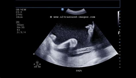 Amniotic Fluid Discharge Images Apothings