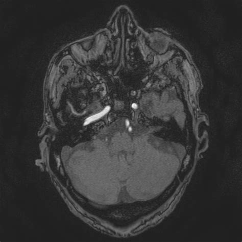 Neurovascular Compression Of Trigeminal Nerve Radiopaedia 67922 77361 Axial Mra Nc Commons