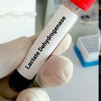 LDH Test Normal Range Types Procedure And Results