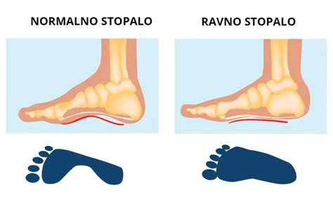 Ravna Stopala Uzroci Simptomi Lečenje Prevencija Ravnih Tabana Bol Rs