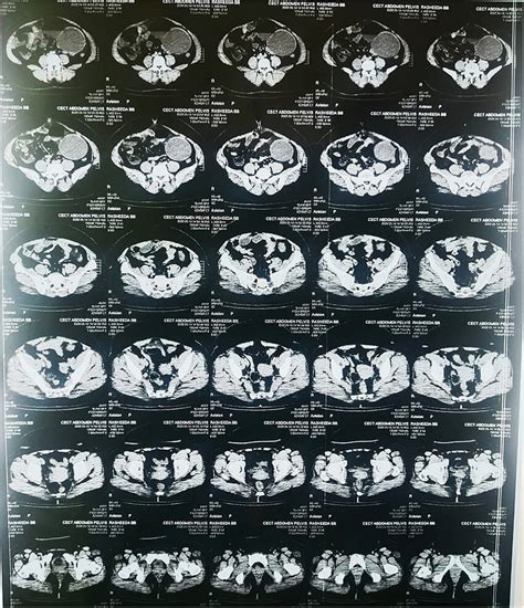Shows Ct Scan Image Of The Duplication Cysts Blue Arrows For Download Scientific Diagram