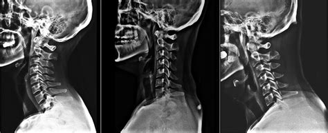 계속 아픈 목통증 어떻게 해야할까 네이버 블로그