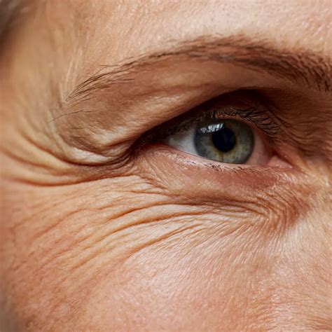 Crows Feet And Under Eye Wrinkles St Louis