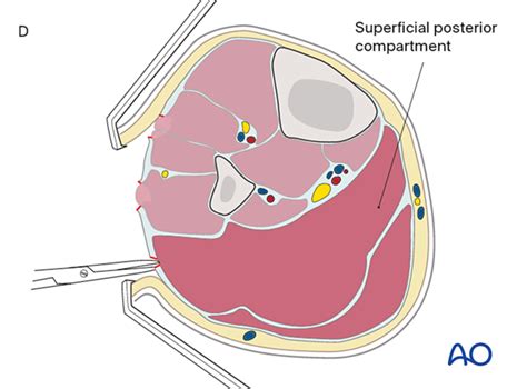 Compartment Syndrome In The Leg