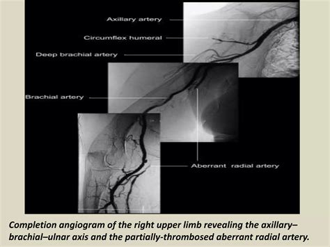 Presentation1pptx Radiological Imaging Of Upper Limb Ischemia Pptx