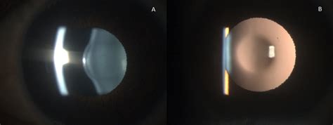 Rare Case Of Anterior Lenticonus Canadian Journal Of Ophthalmology