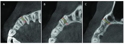 Measurement Of Alveolar Bone Width And Bone Density In Roi Width 1