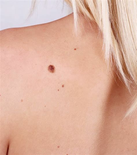 Treatment For Brown Spots Advanced Dermatology Pc