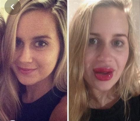 Too Much Lip Filler Lip Enhancement Plastic Surgery Bad Lip Injections
