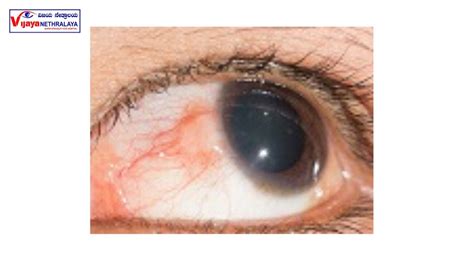 Episcleritis Pictures Symptoms Treatment Causes Episcleritis