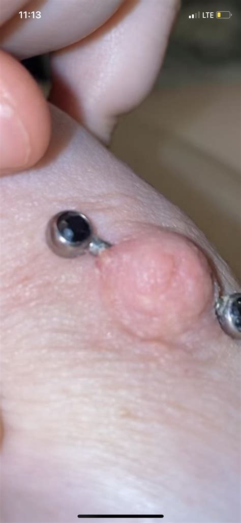 Nsfw Does This Look Like A Keloid Starting I Was Going To Clean It