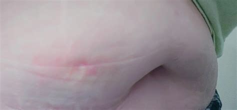 1st Sublocade Injection Rsublocade